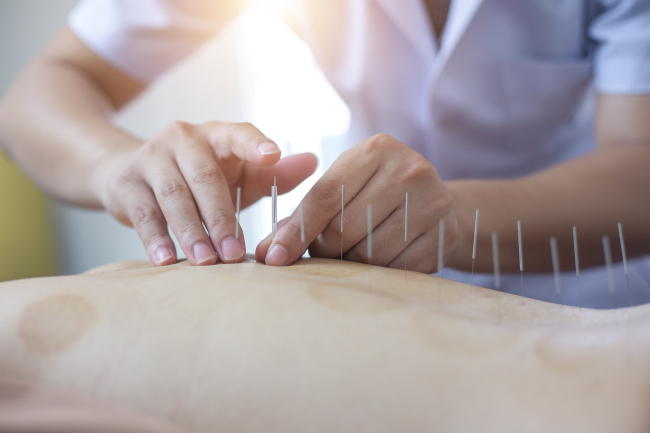 Acupuncture for Sciatica, Pickering, ON | Active Integrative Medicine